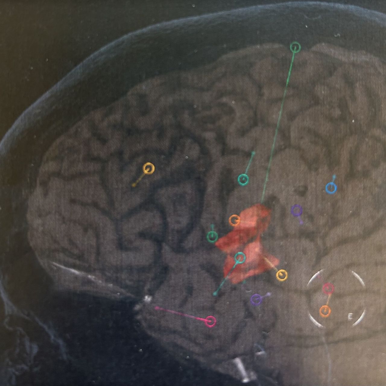 Dette skulle jeg visst om SEEG | Blogg | Epilepsiforbundet